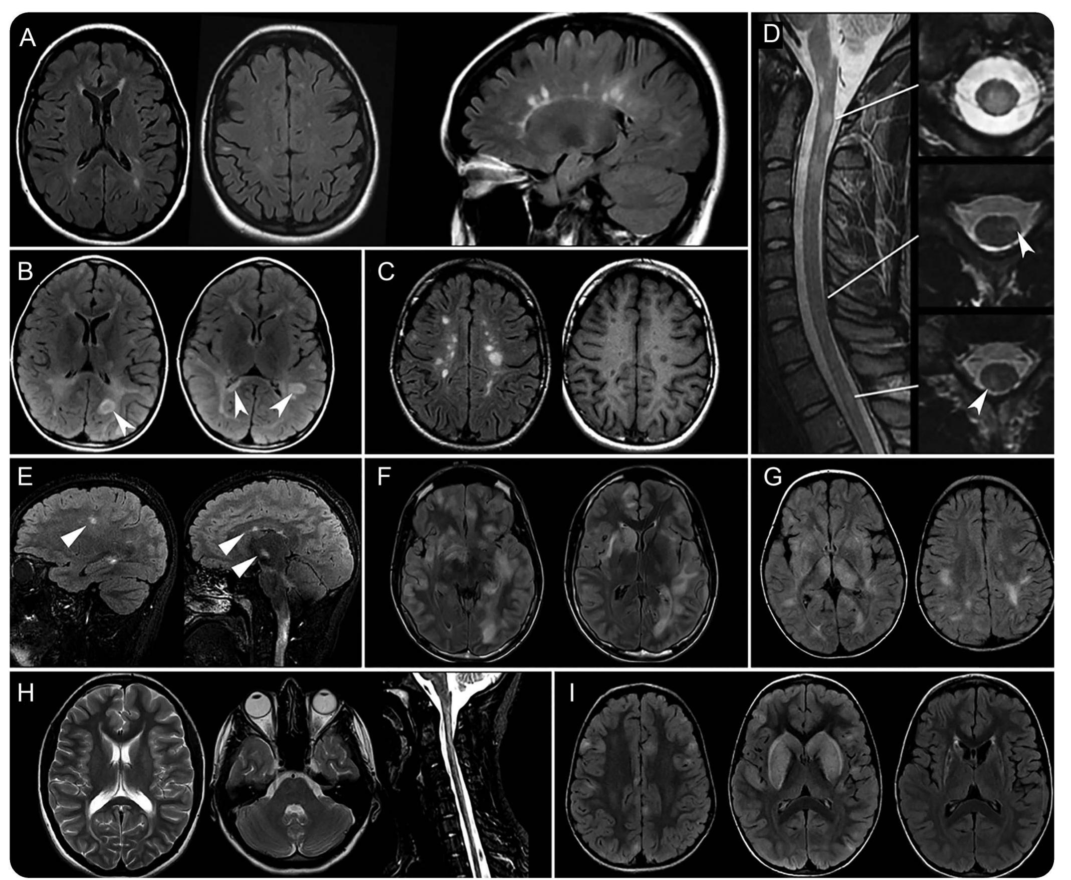 Examples of typical demyelinating lesions of pediatric