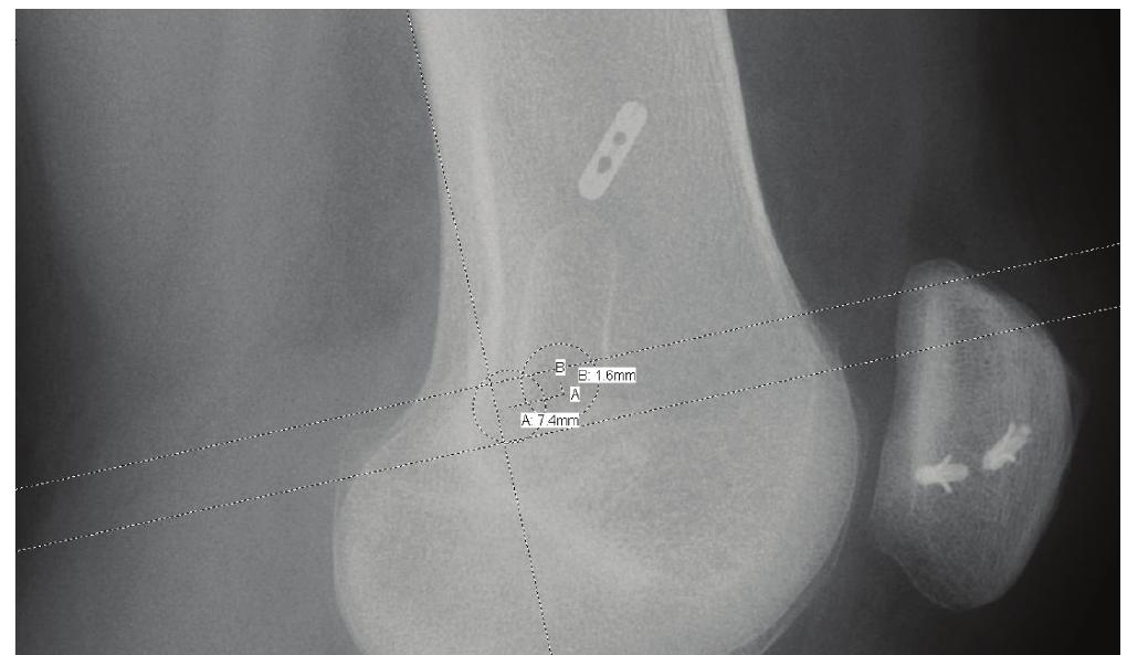 Sample radiograph, showing the distance anterior and
