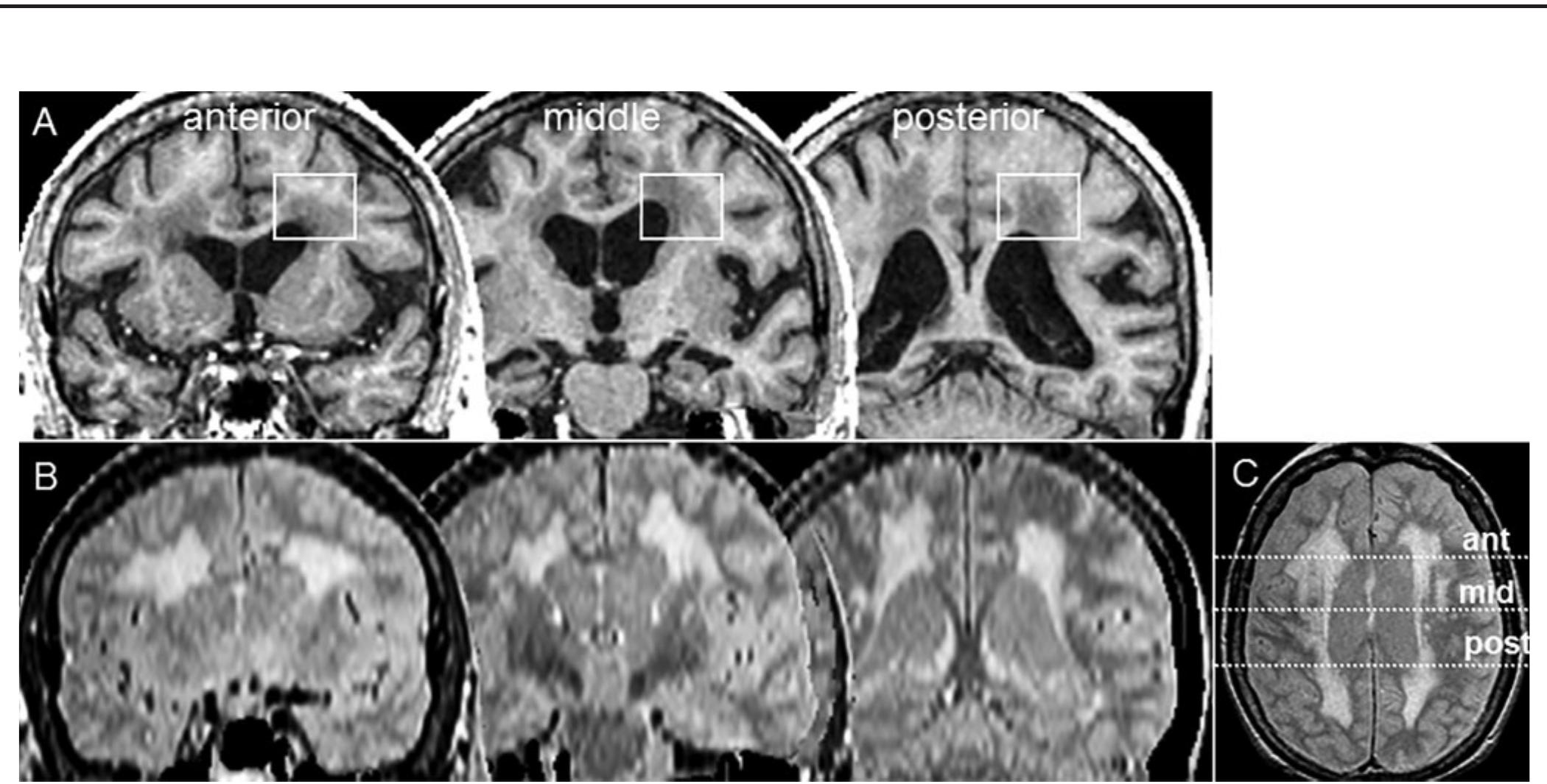 (a) coronal t1-weighted mr images demonstrating the areas of