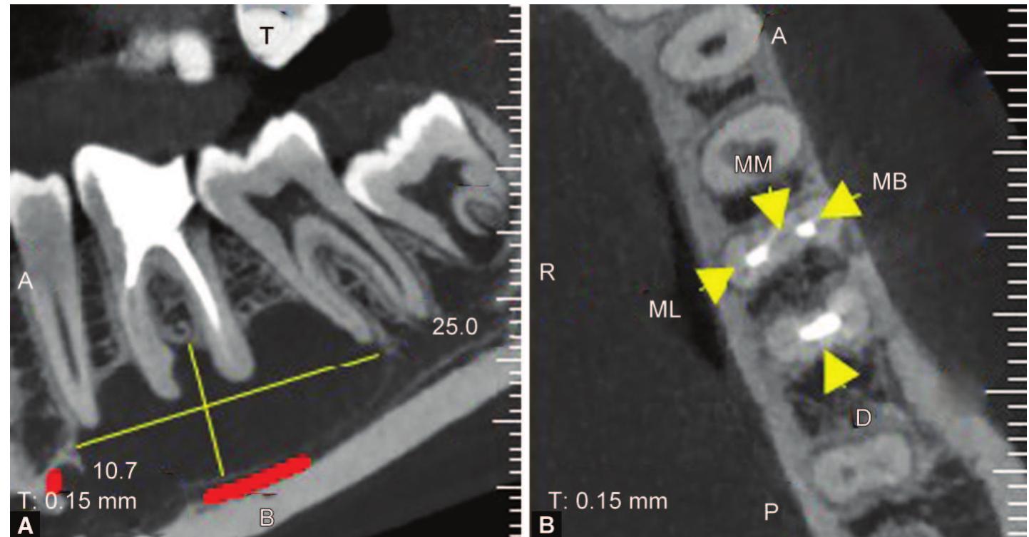 S 2a and b: (a) cbct images: (a) sagittal view; (b) axial