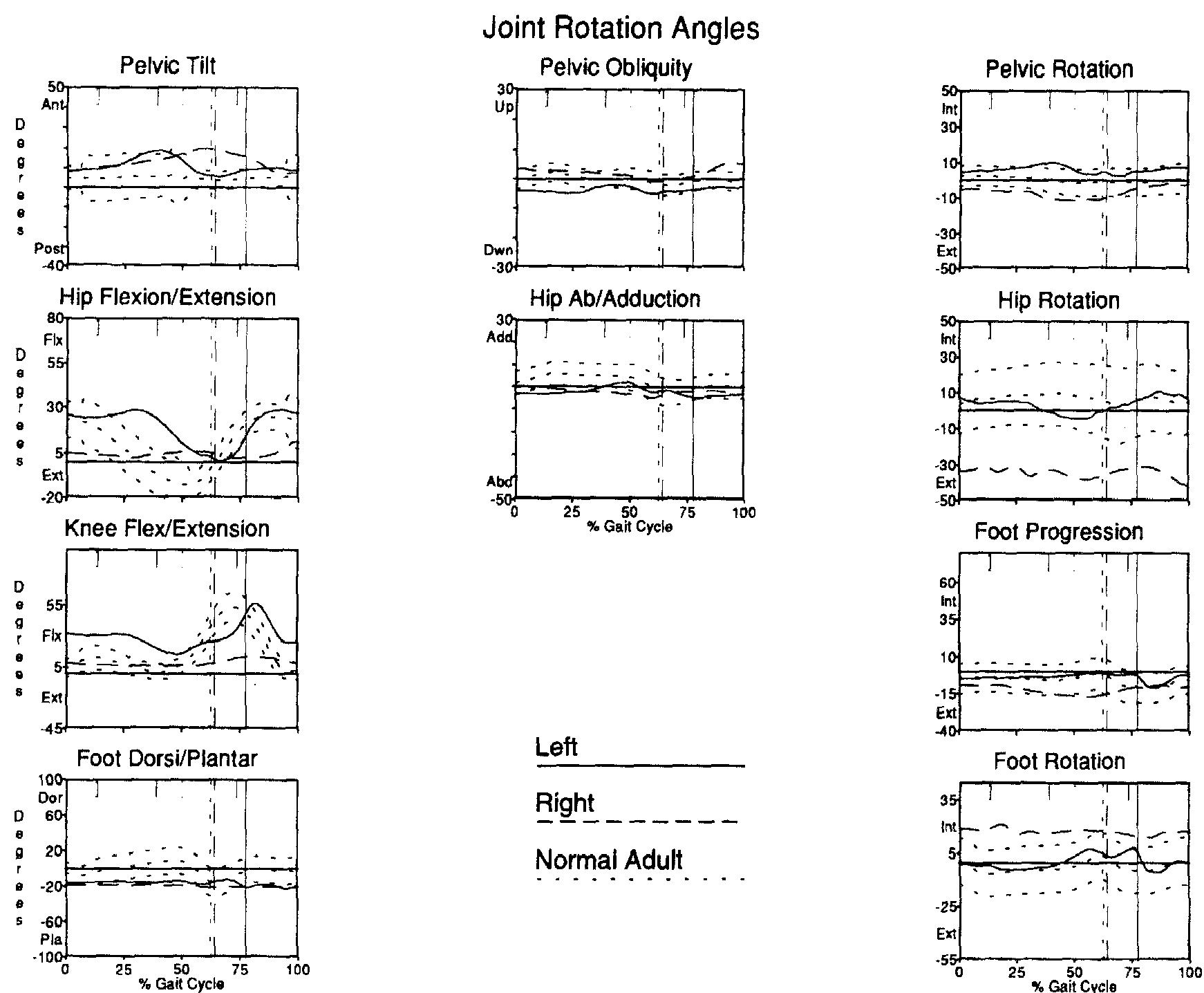 Kinematic joint plane angles of hd amputee patient and