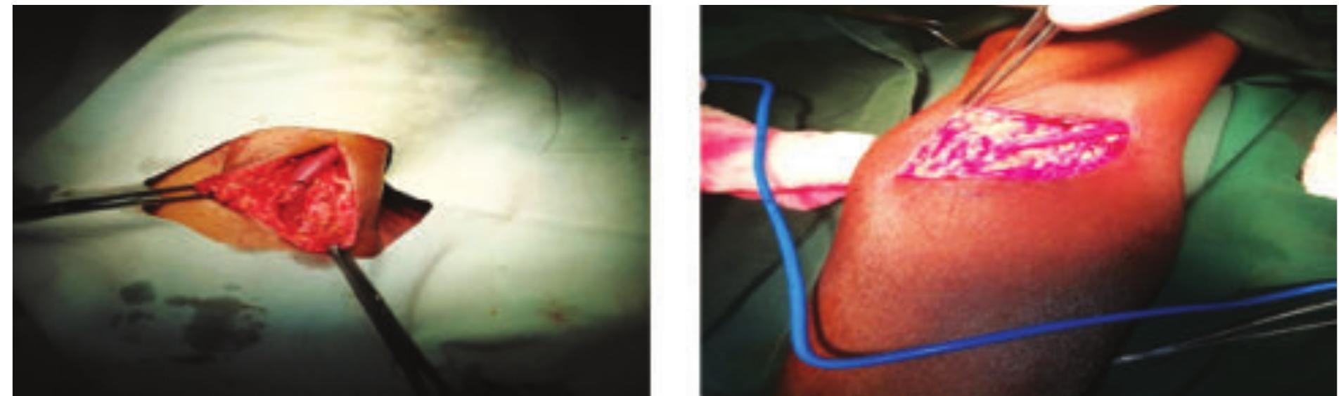 -1 a & b: distal radio-cephalic fistula & brachio-cephalic