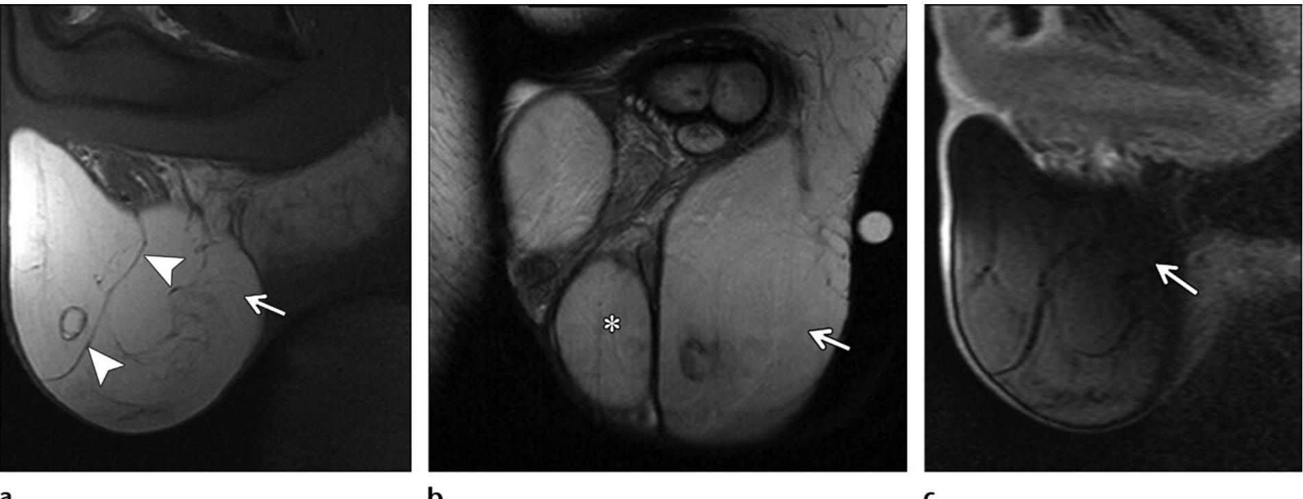 Extratesticular lipoma in a 40-year-old man. (a, b) sagittal