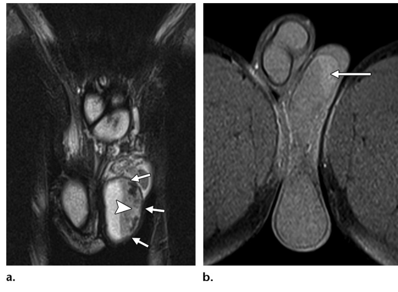 Blunt scrotal trauma may cause contusion, hematoma,