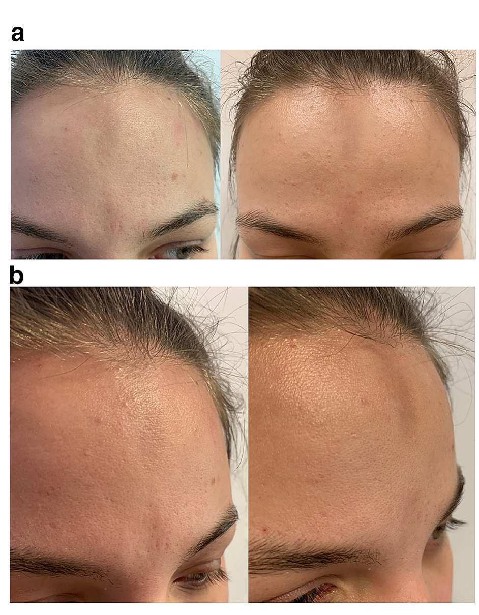 The patient before and a week after the injection of voluma