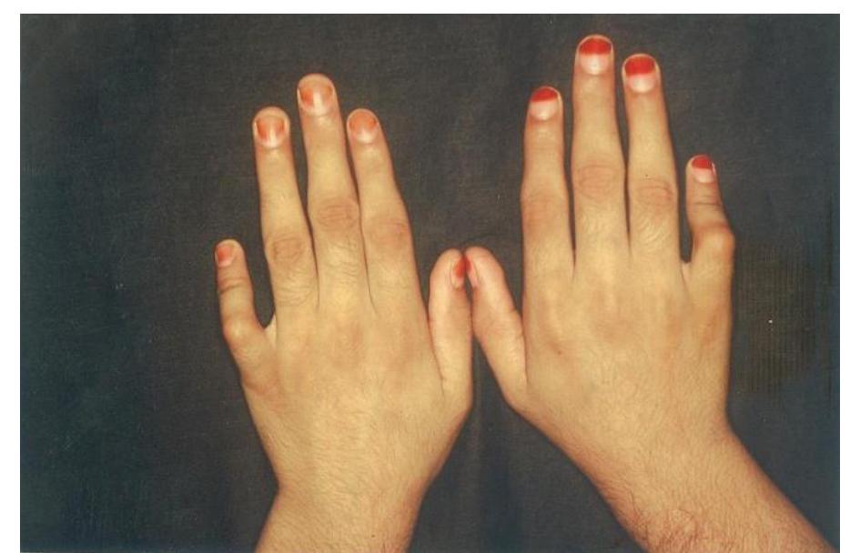 Flexion contractures of little fingers. the patient was born