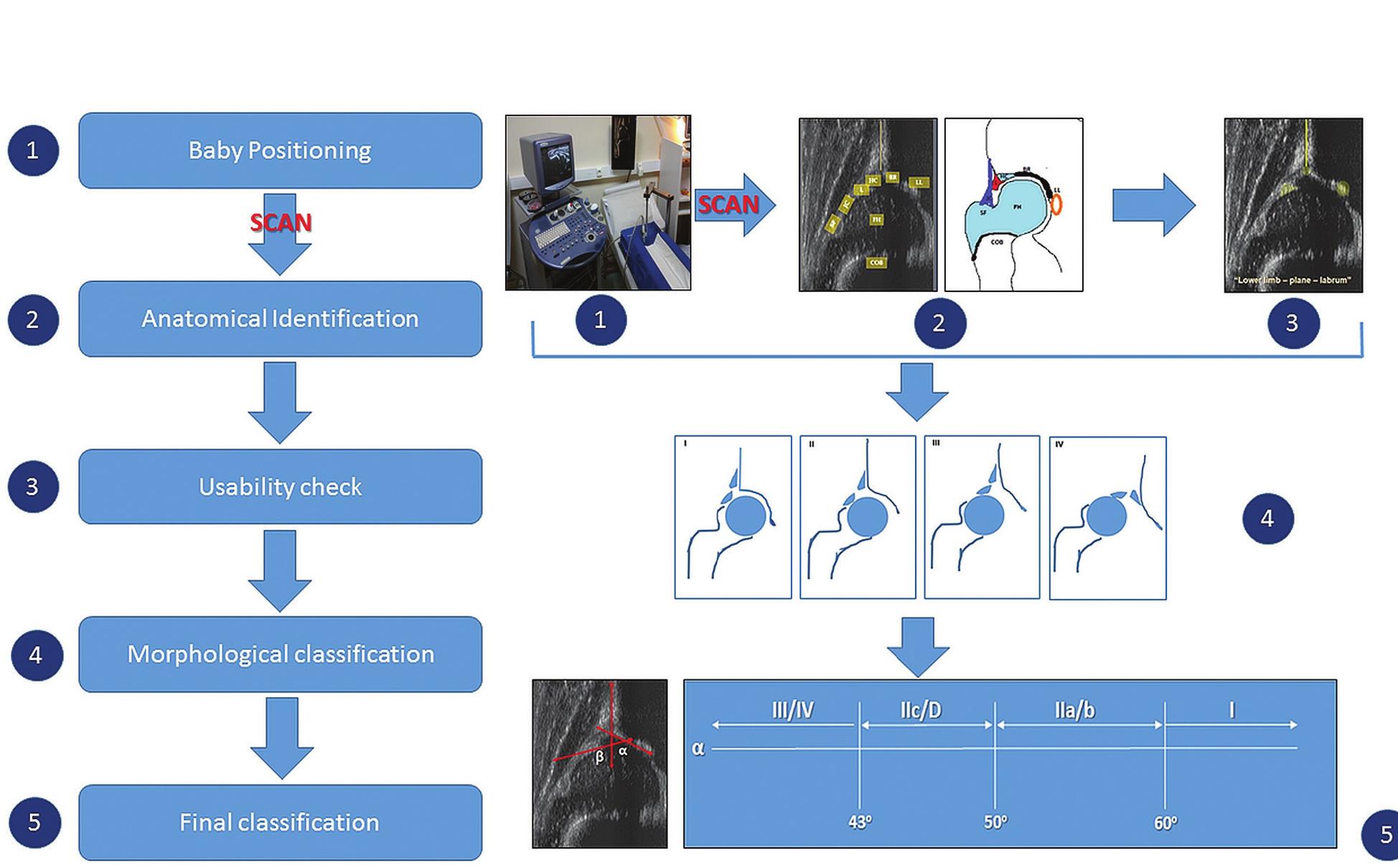 Graf’s technique offers a well-structured anatomical