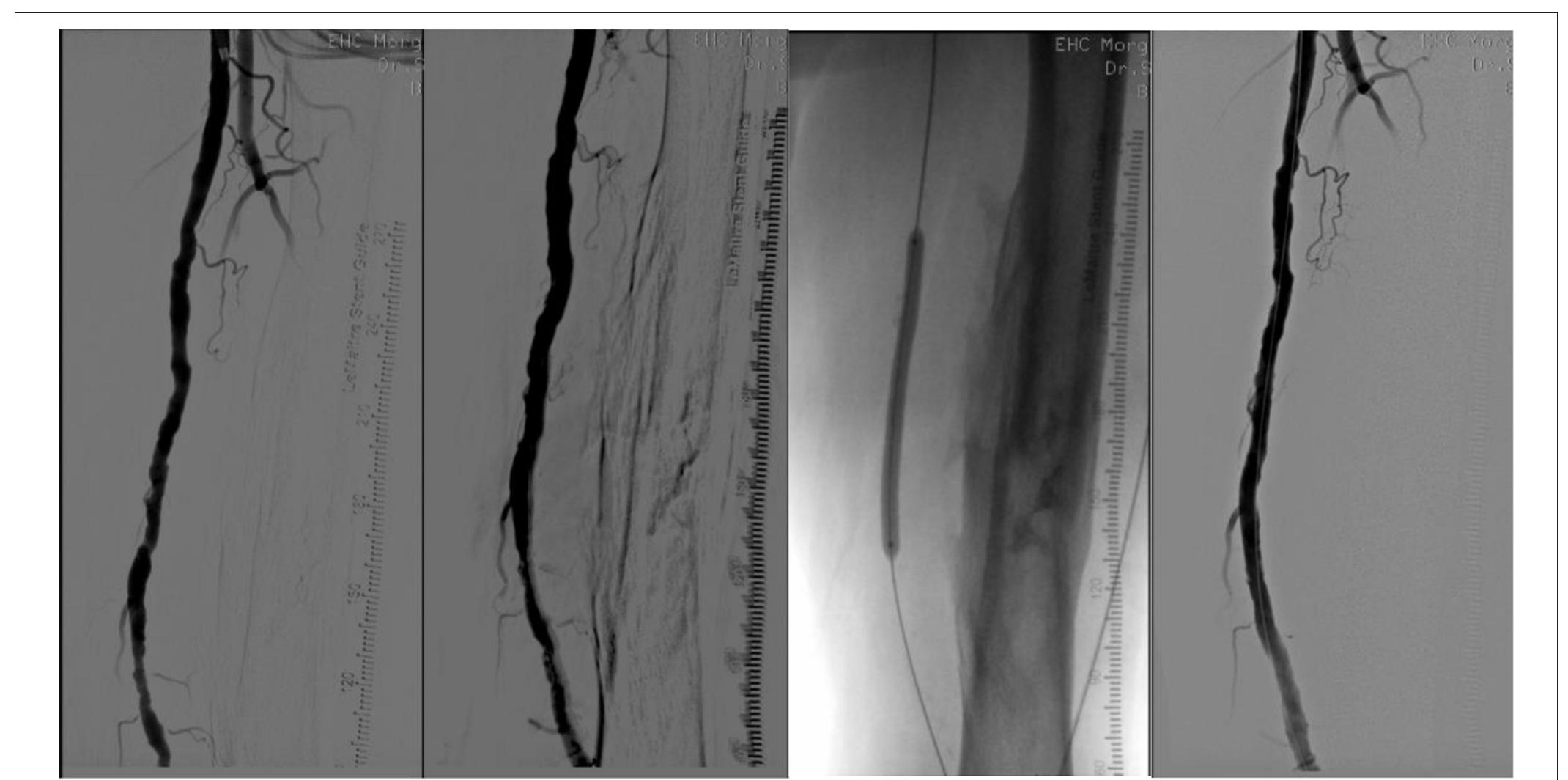 | from left to right. (1) long superficial femoral artery
