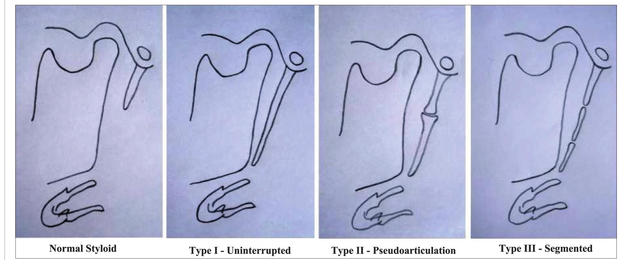 The diagram shows langlais classification of the type of