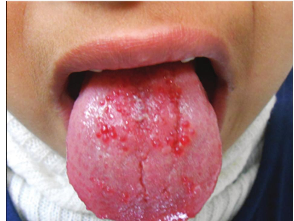 Erythematous raised lesions on the posterior part of the