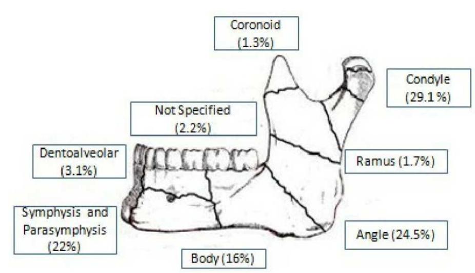 Classification of mandibular fracture according to