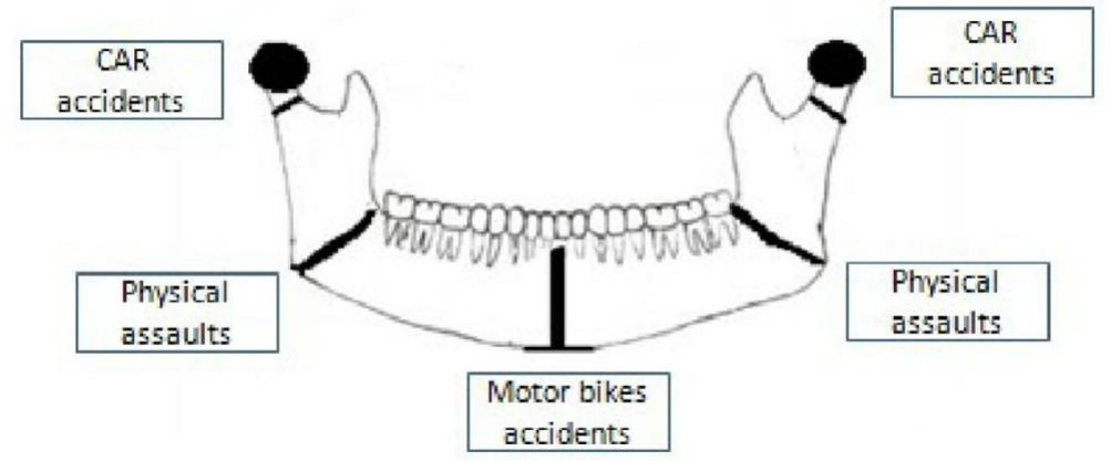 Etiologic classification of mandibular fracture. occlusion,