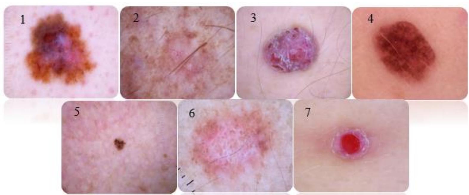 Types of skin lesions [1. melanoma (mel), 2. squamous cell