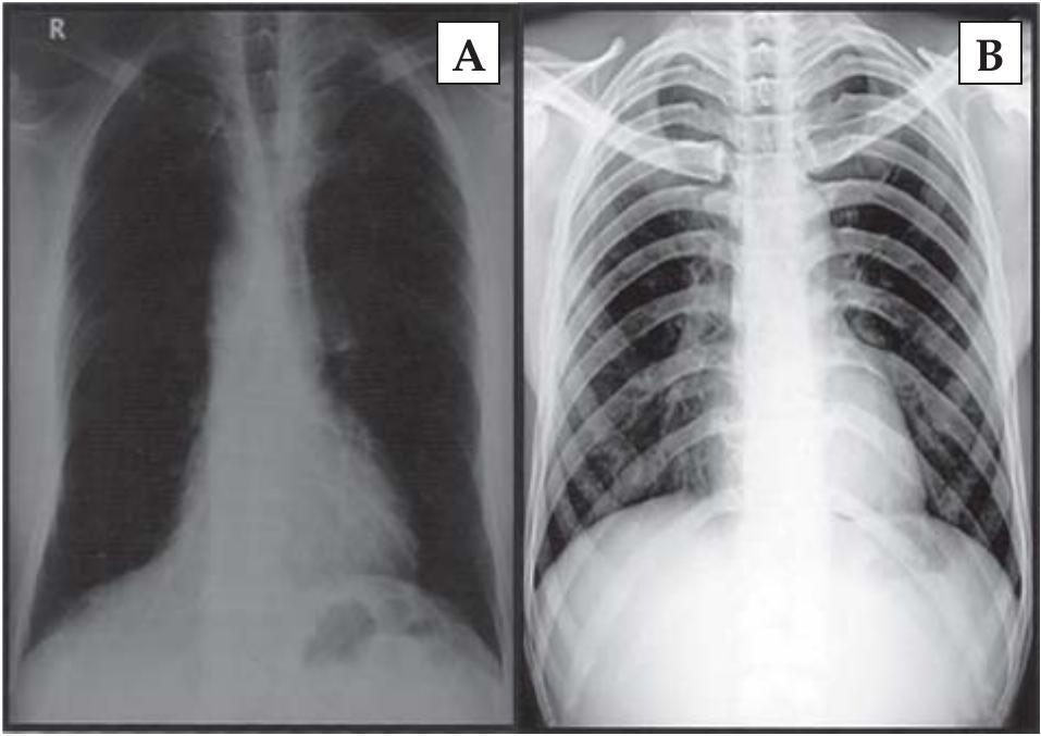 Chest radiograph (postero-anterior view) showing (a) absent