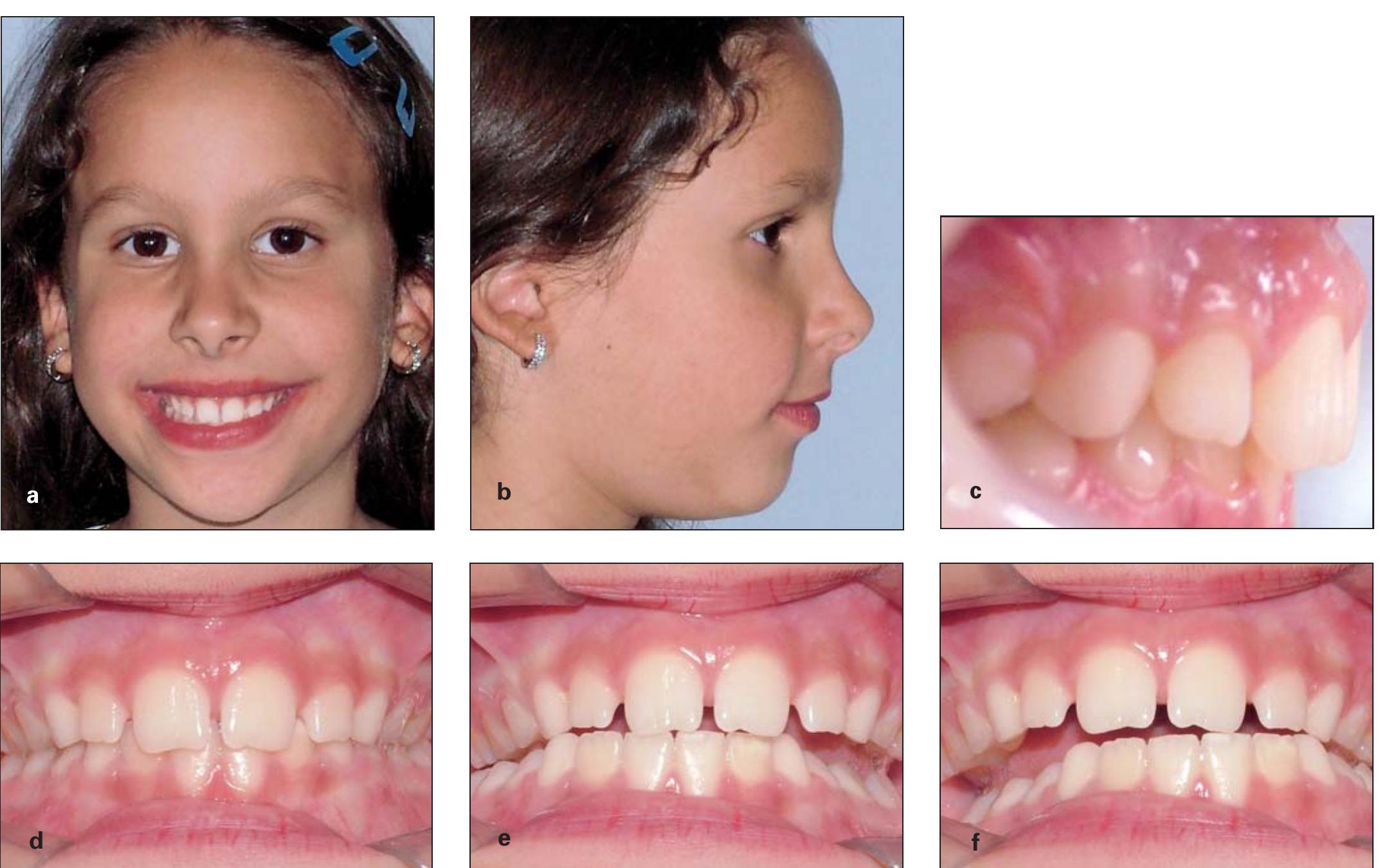 Case 2. note eruption of second primary molars, 6 months