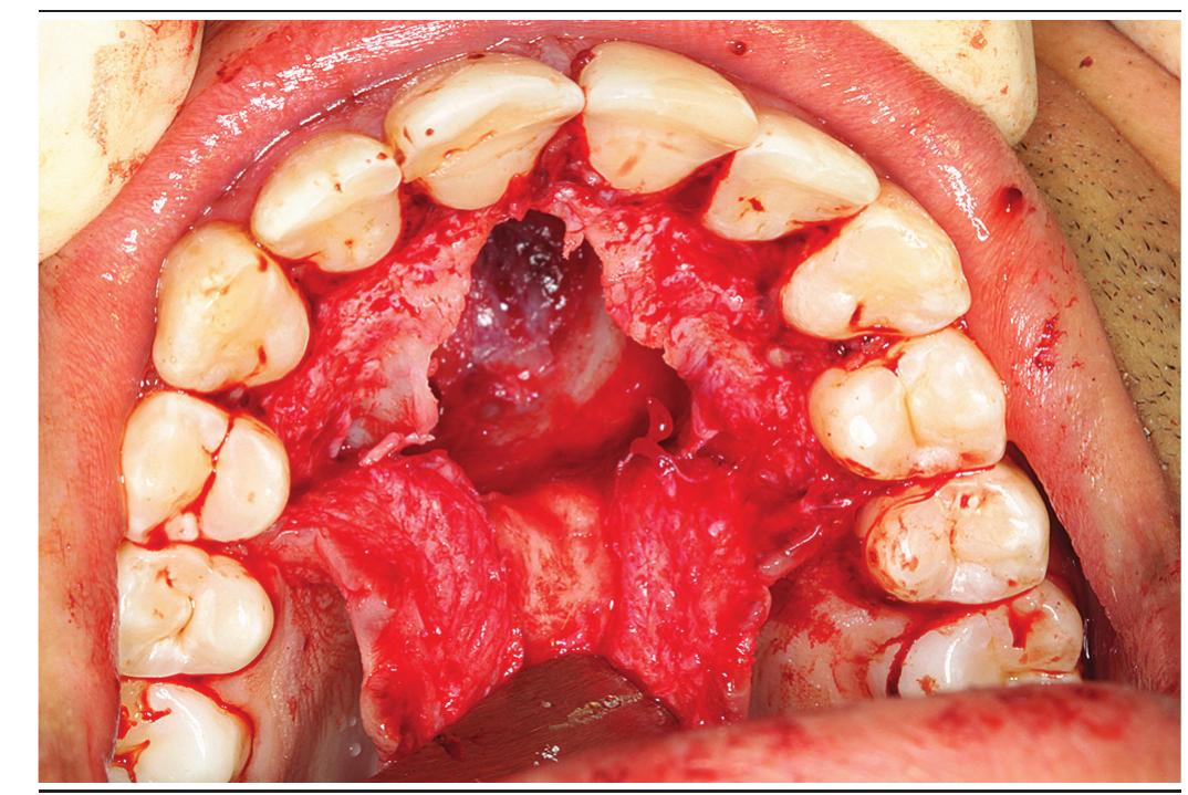 Figure 12 - Nasopalatine duct cyst – diagnosis, treatment