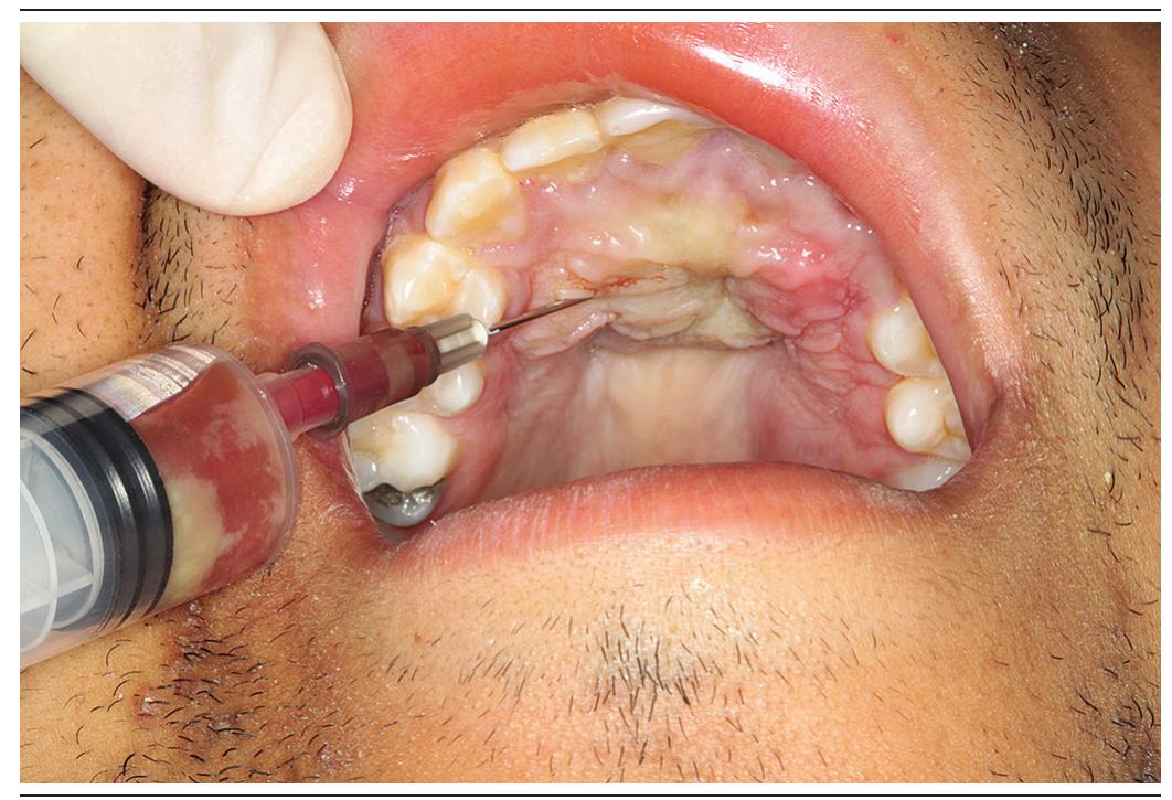 swollen anterior hard palate of patient of case 2, 28 days