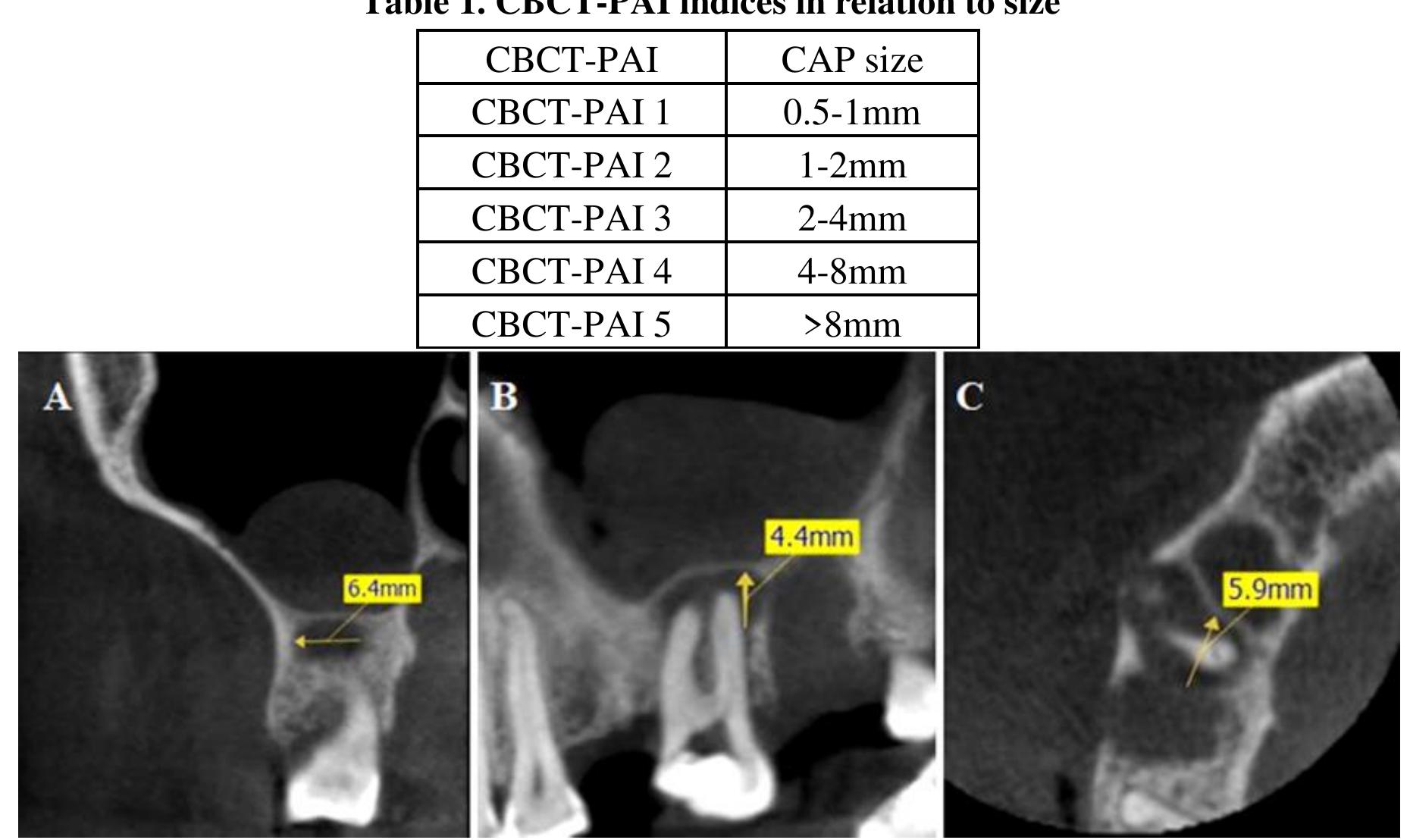S 1.a-c. s.l., age 38. chronic apical periodontitis 1.6.