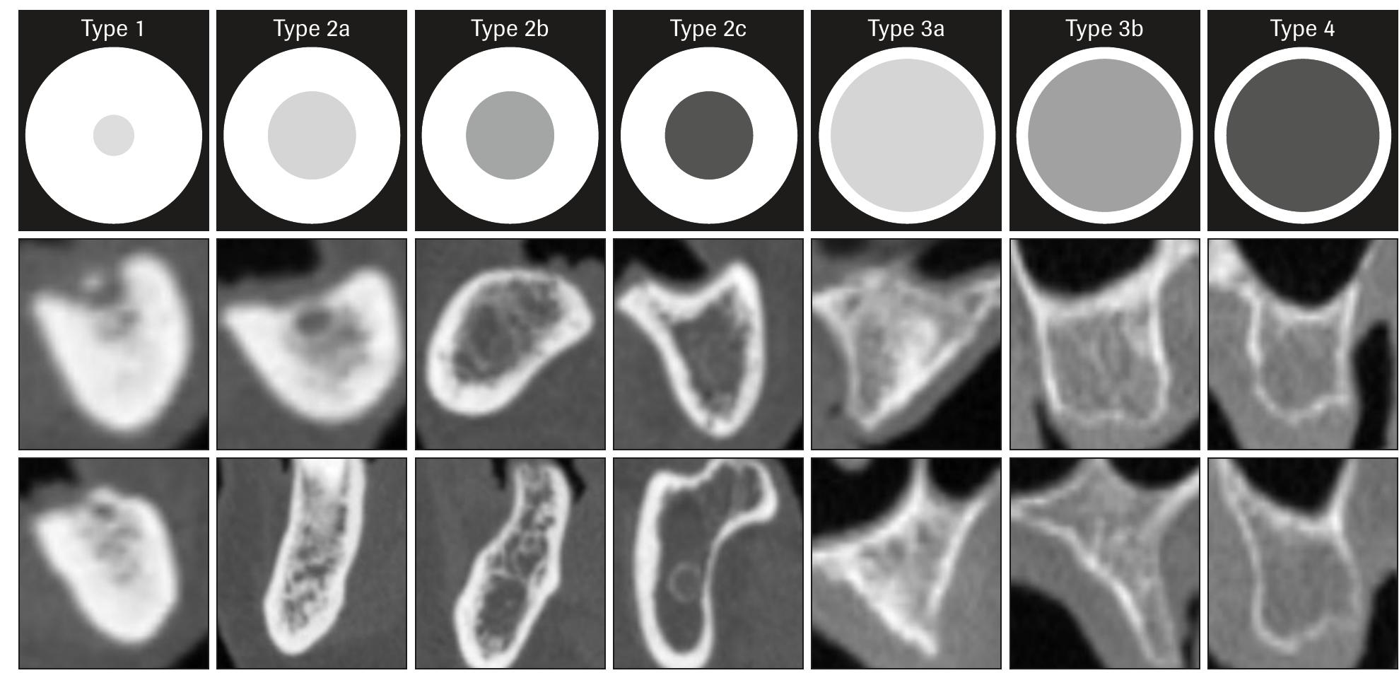 (PDF) Revised, Computed Tomography–Based Lekholm and Zarb Jawbone ...