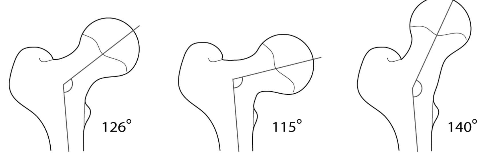 (2). (a) normal femoral neck angle, (b) a decreased femoral