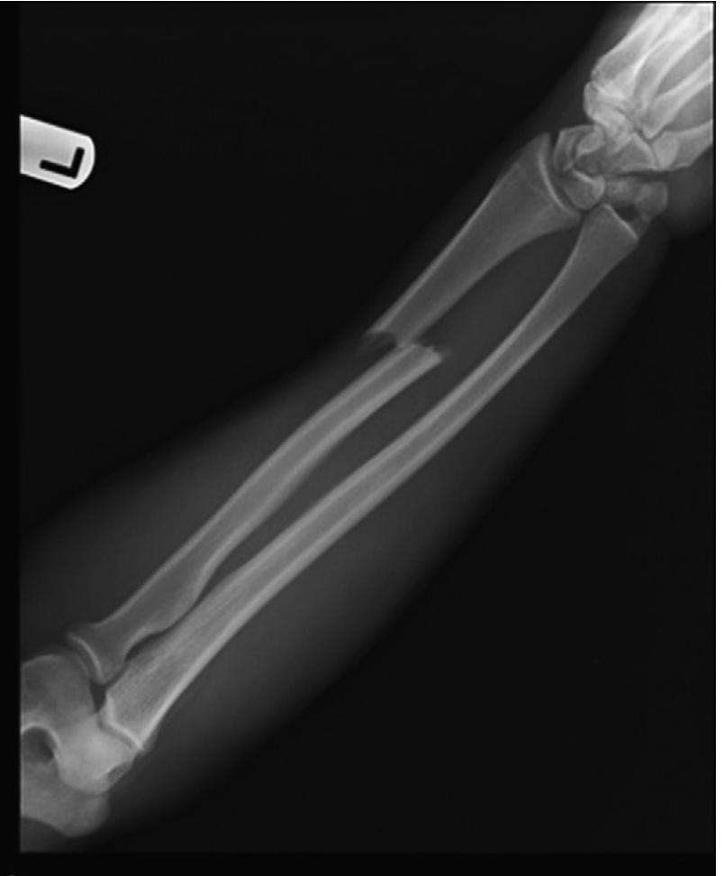 Clinically, tenderness to palpation at the druj in the