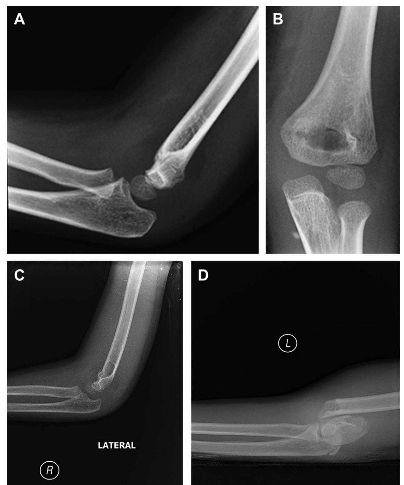 Supracondylar fracture type |. (a) lateral view. notice the