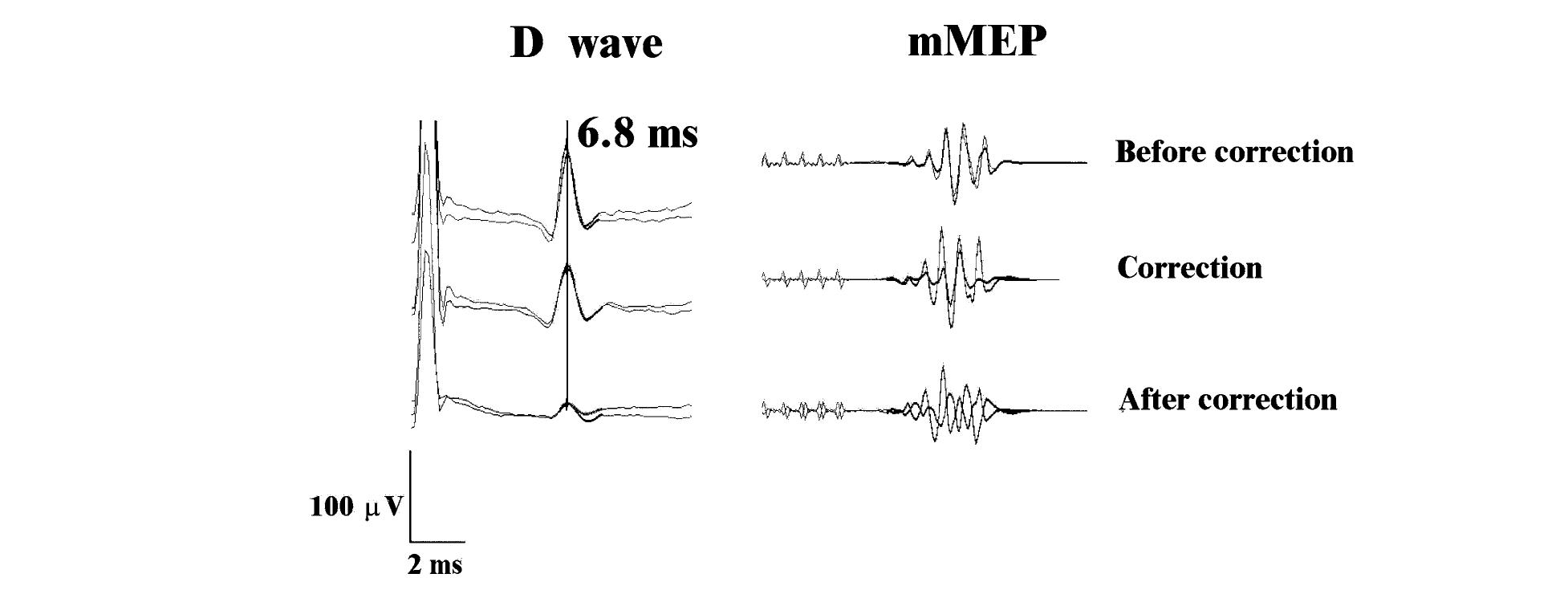 Benign d wave reduction during scoliosis surgery. marked d