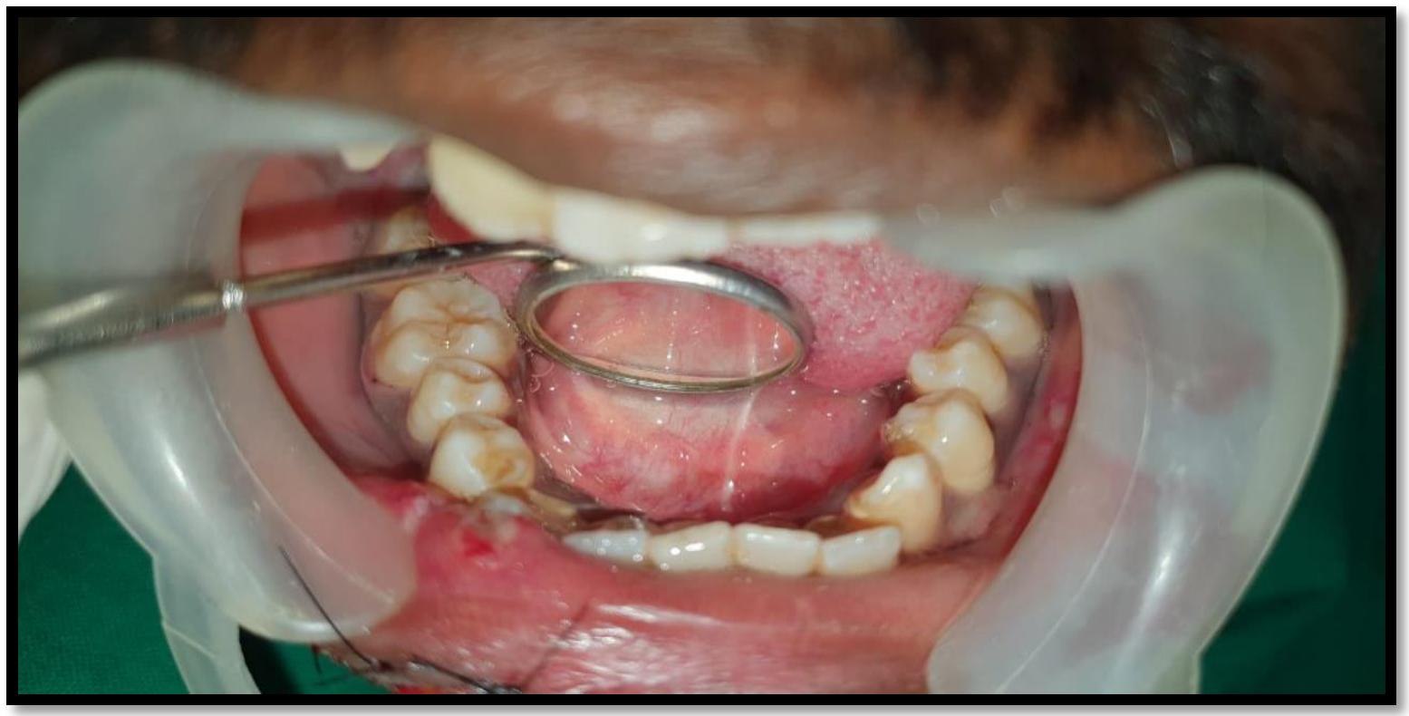 Figure 1 - Coleman Sign: A Hallmark For Mandibular Fracture?