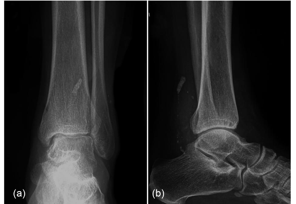 Ap radiograph (a) and lateral radiograph (b) of the right