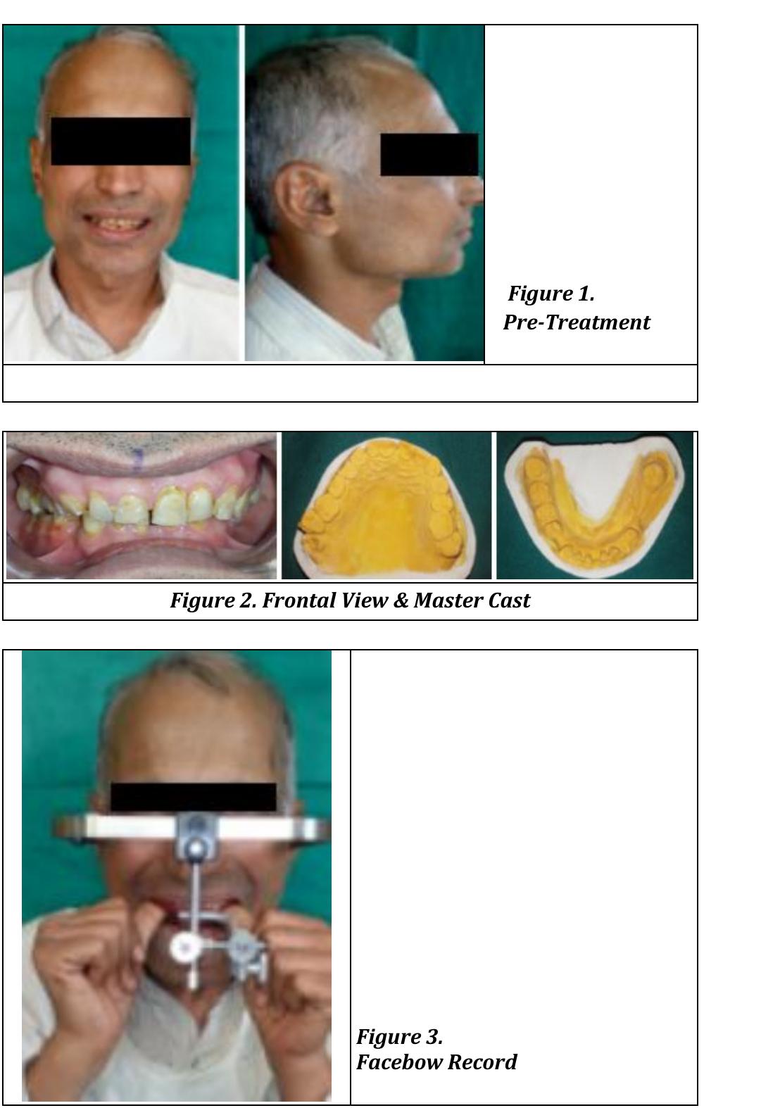 The maxillary and mandibular diagnostic impressions were