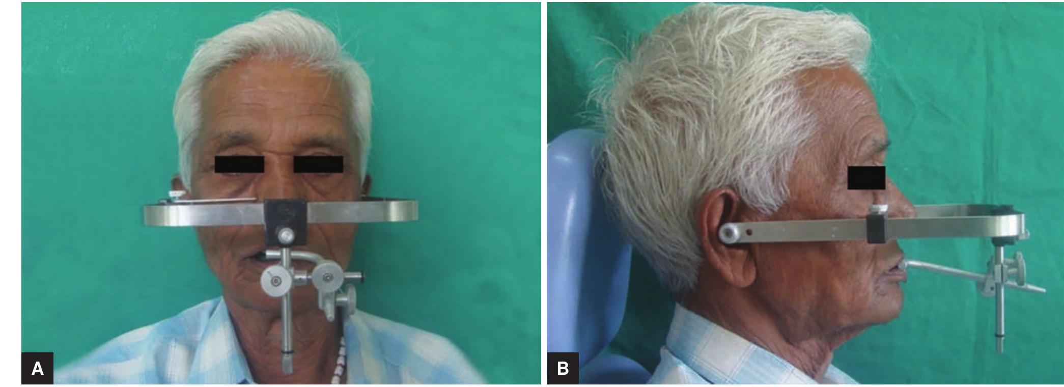 The compound mandibular occlusal rim was then removed from