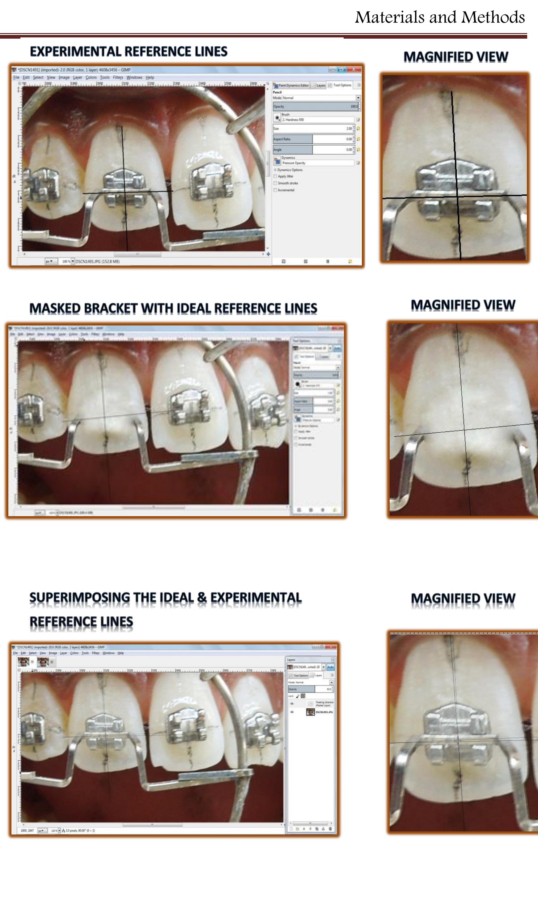 Figure 7 - Accuracy of Bracket Positioning in Direct and