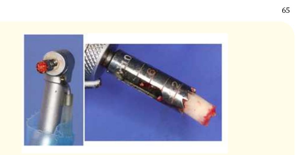 Alveolar ridge preservation in mandibular molars using