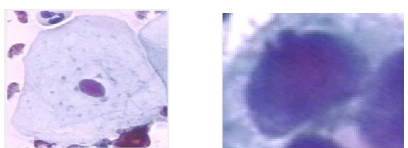 La: normal cervix cell fig 1b. abnormal cervix cell.