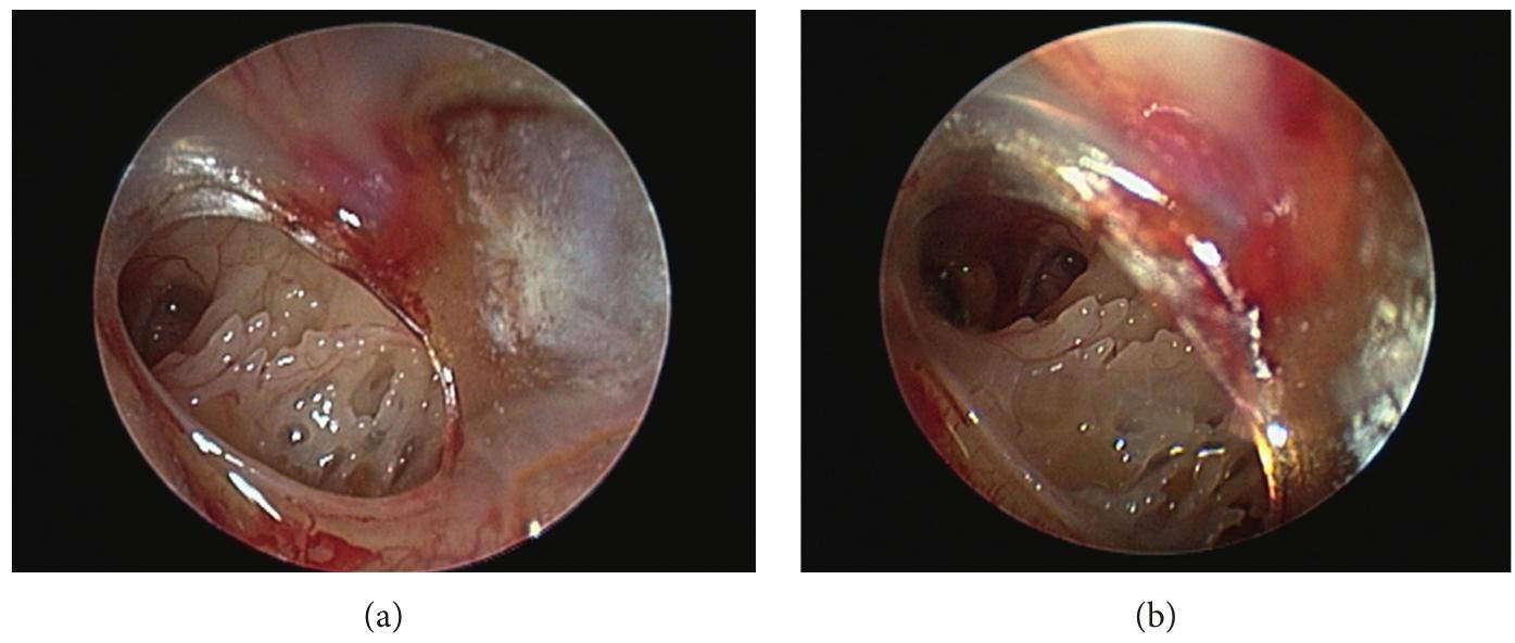 Left-sided anterior-inferior tympanic membrane perforation
