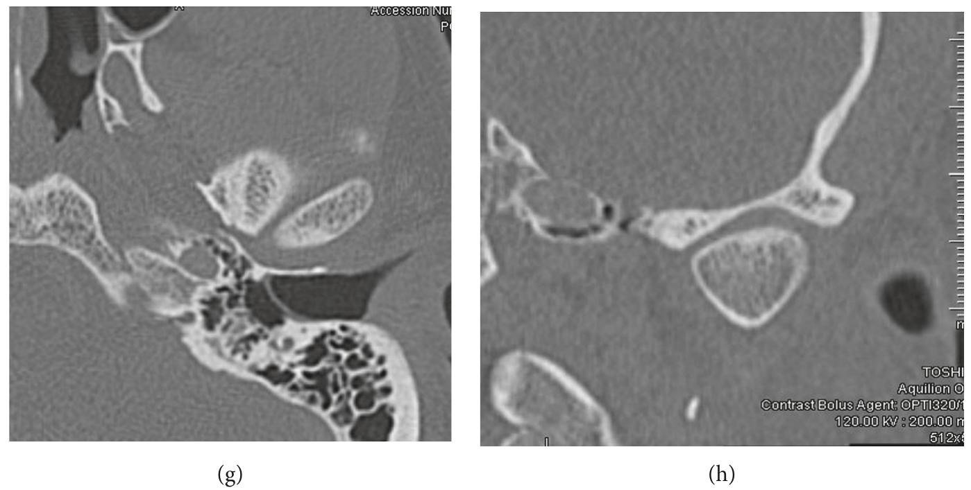 Figure 4 - Eustachian Tube Foreign Body with