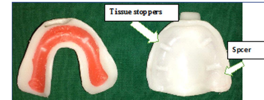 [table/fig-3]: thermoplastic mandibular and maxillary trays