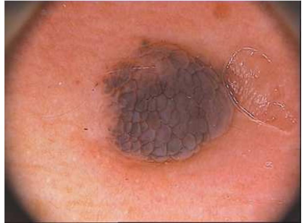 Figure 9 - Dermoscopy: basic concepts
