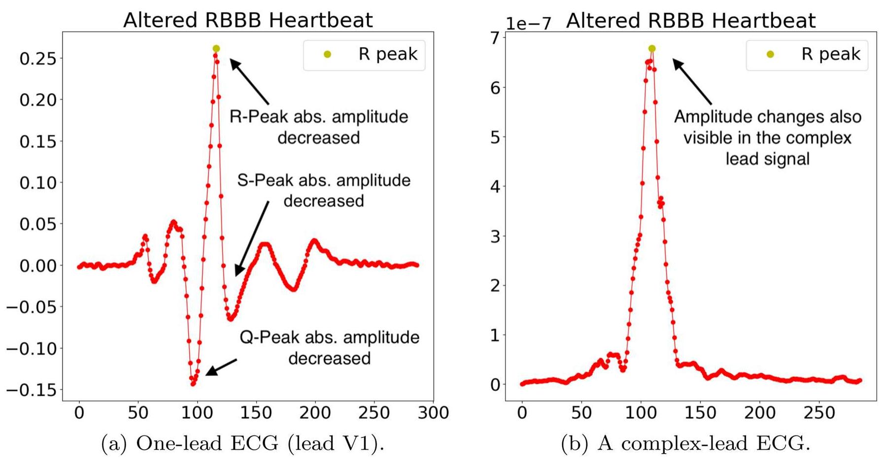 A sample augmented ecg segment. (see the supplement (boynton