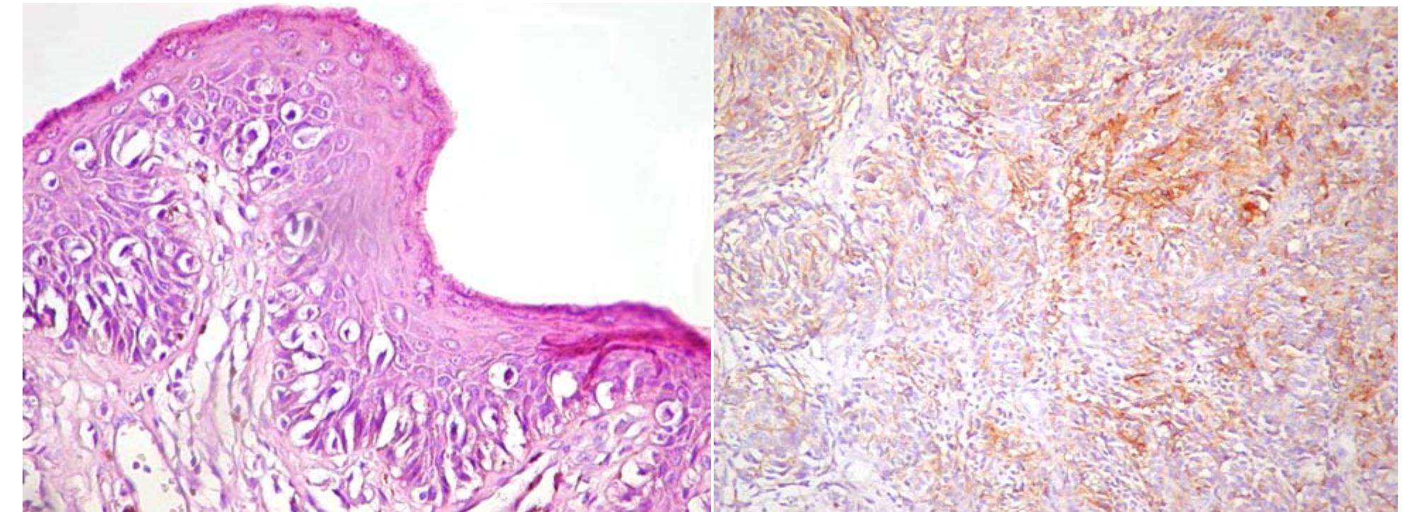Figure 4 - from Amelanotic vulvar melanoma: case report and