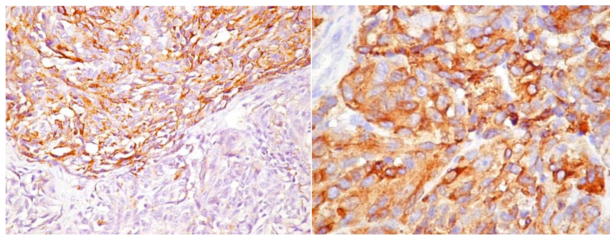 Figure 6 Amelanotic Vulvar Melanoma Case Report And