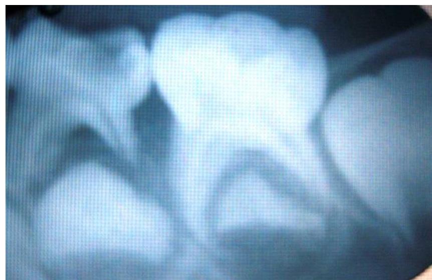 Iopar of the right mandibular first molar region journal of