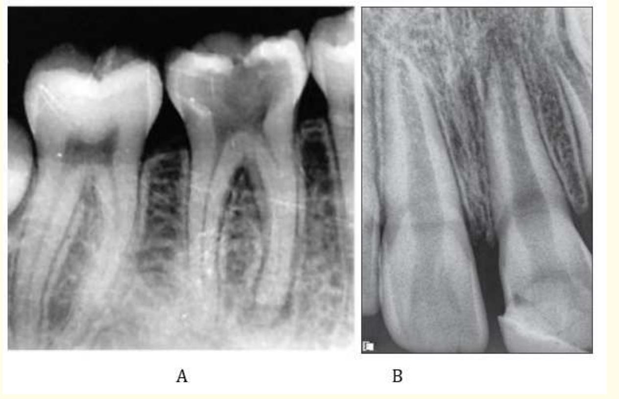 Showing a) periapical radiolucency at the mesial root of