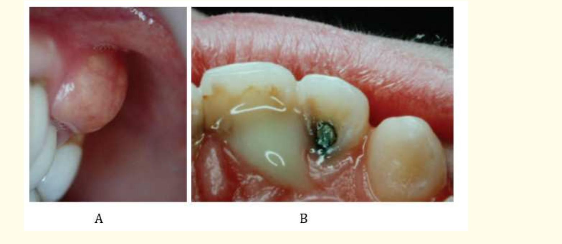 Showing a. soft intra-oral swelling. b. drainage of the