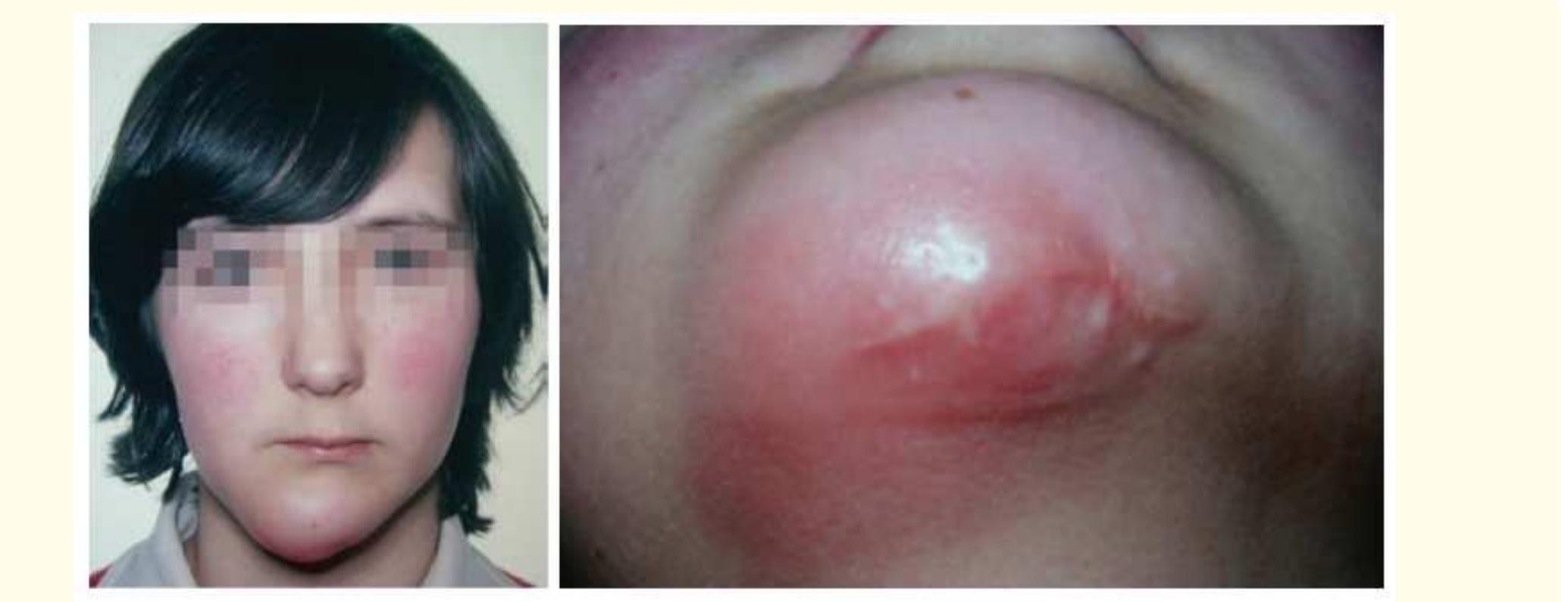 Showing extra-oral swelling due to periapical lesion of