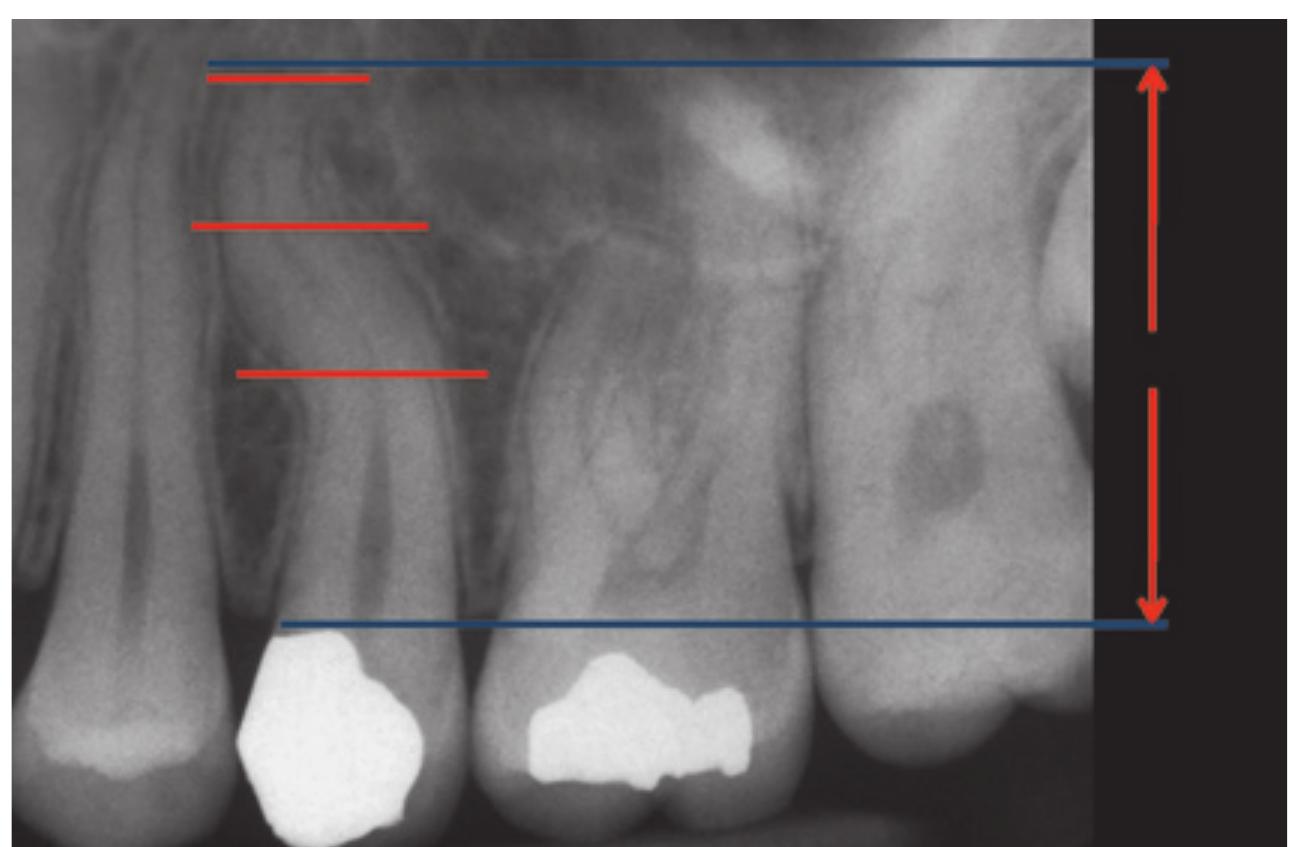 Division of the s-shaped root into thirds, which allows the