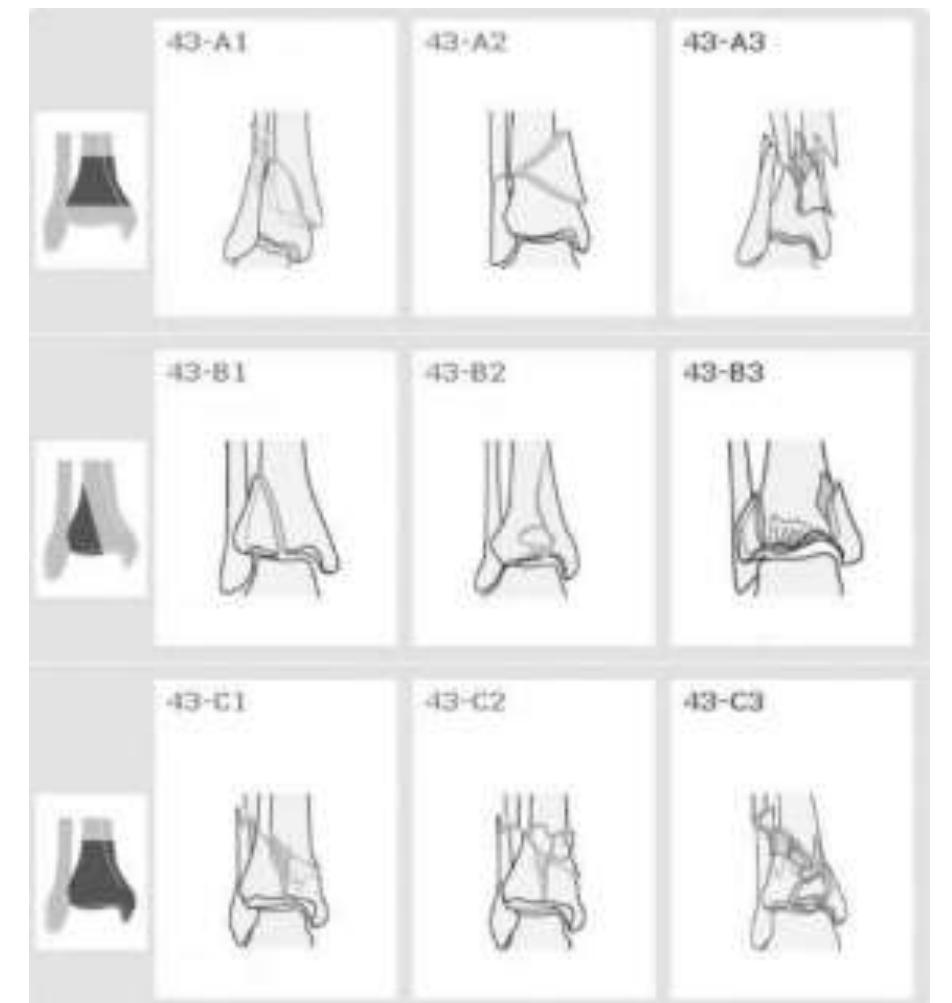 Ao classification of distal tibia fractures