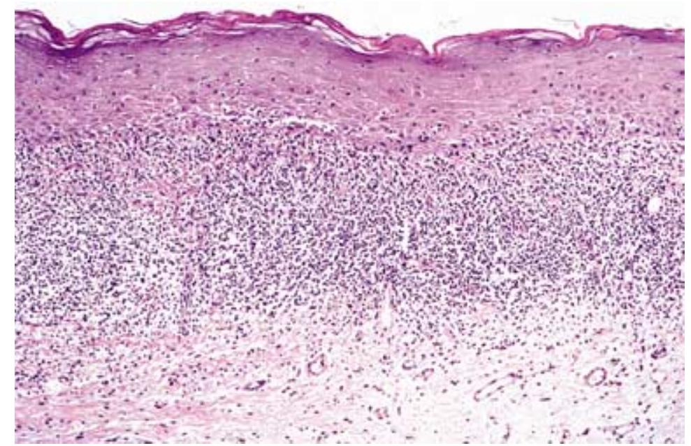 Histology of oral lichen planus shows hyperkeratosis of the