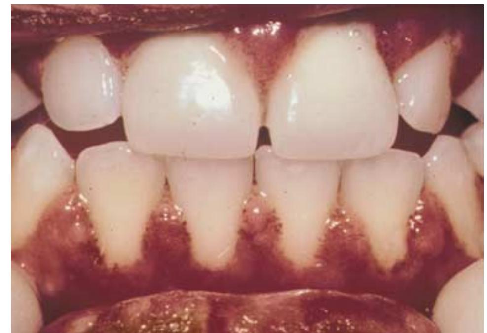 Primary herpetic gingivostomatitis typically has an acute