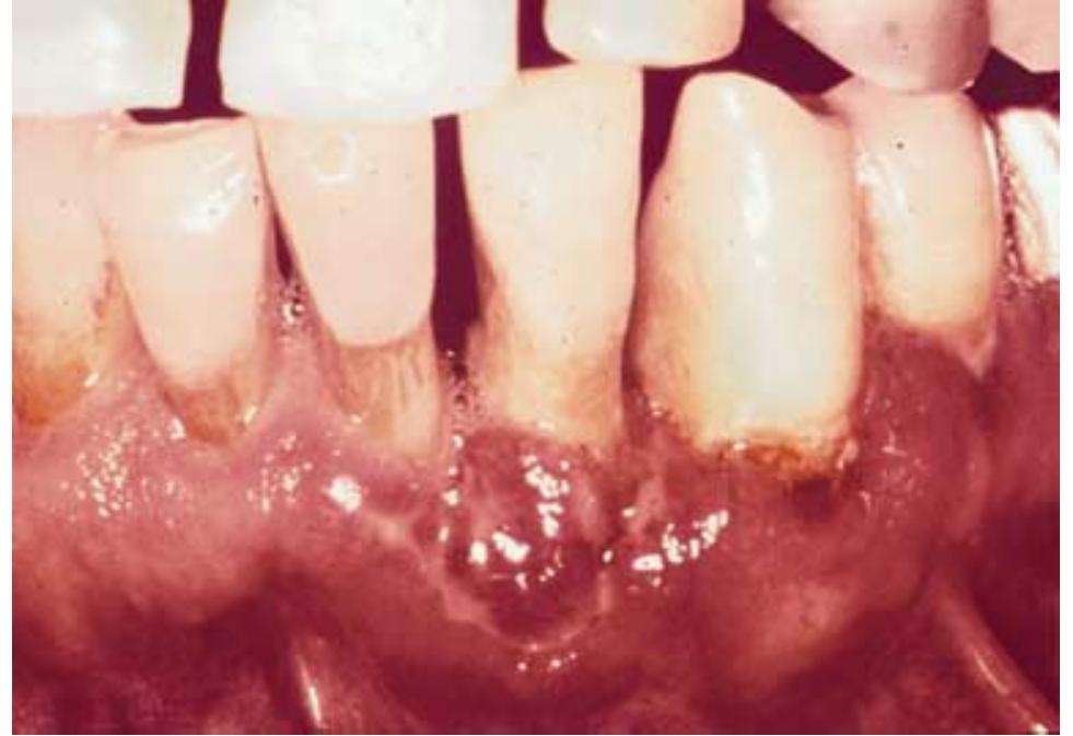 A solitary ulcer causing bone loss around a mandibular tooth